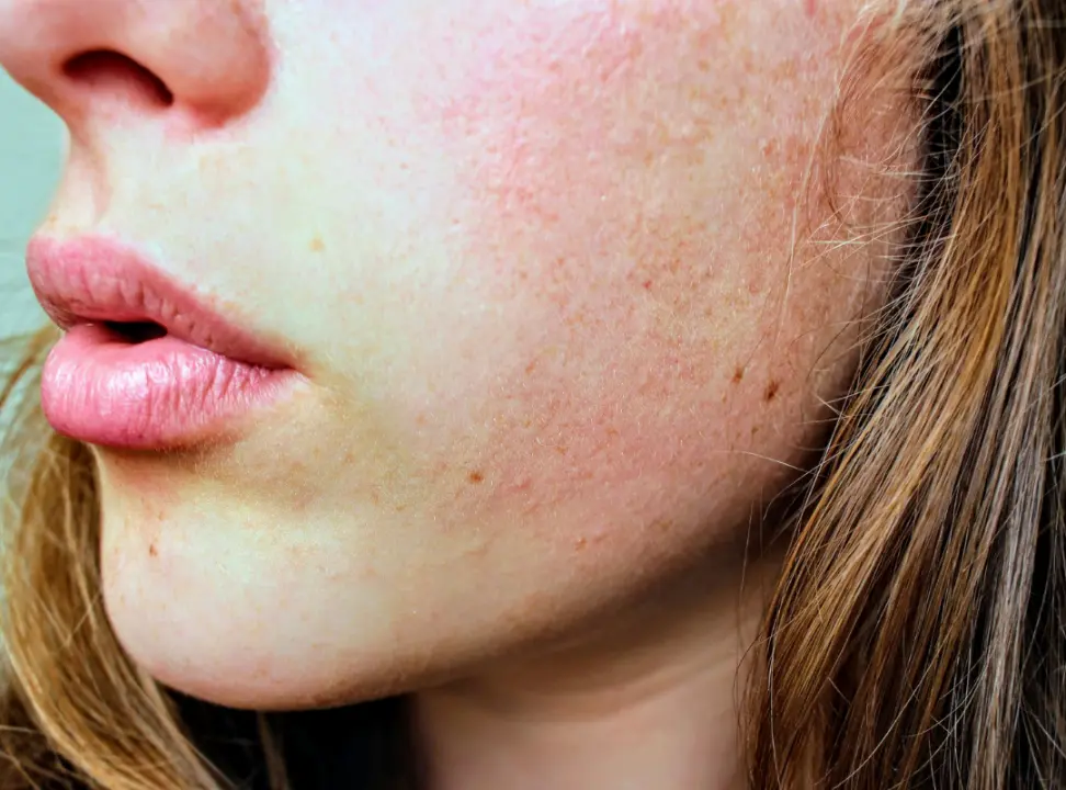 What Causes Large Pores and How Do I Treat Them | Skin Artistry Clinic